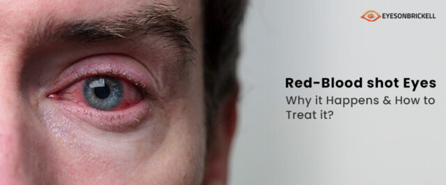 Causes & Treatments Of Red Bloodshot Eyes | Eyes on Brickell
